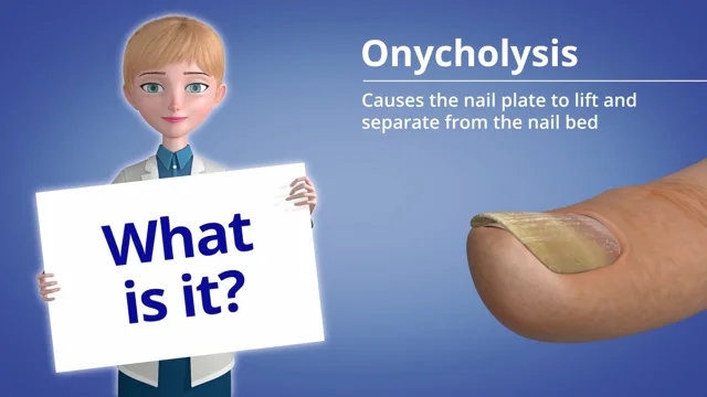 Onycholysis