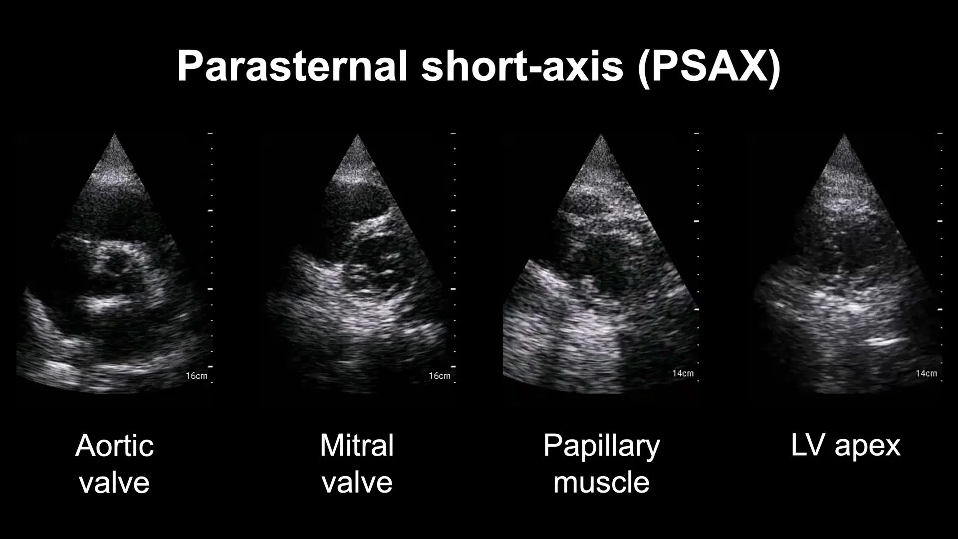 echocardiogram-standard-PSAX-view-video